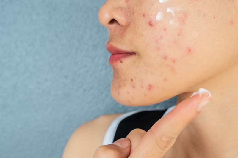 Acne-Derm (krem) – jak stosować, efekty, skład, ulotka