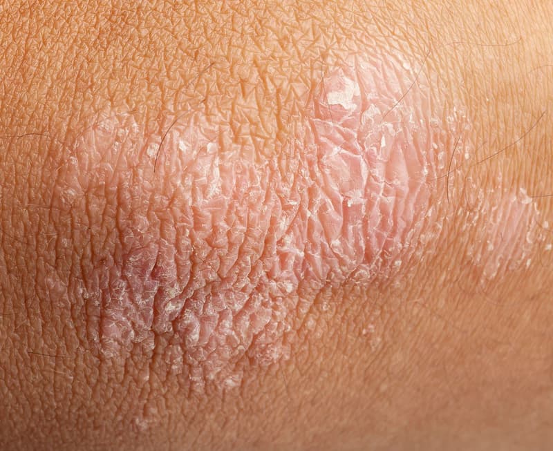 Ziarnina, ziarninowanie – na czym polega gojenie rany przez ziarninowanie?