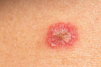 Dermatofity – co to jest, przyczyny zakażenia, rodzaje, badania ...