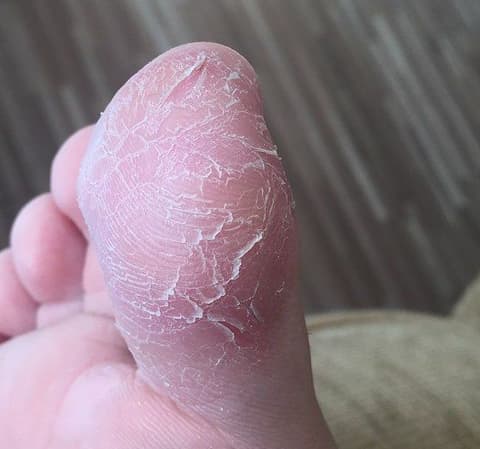 Grzybica stóp – przyczyny, objawy, rodzaje, jak wygląda, zdjęcia