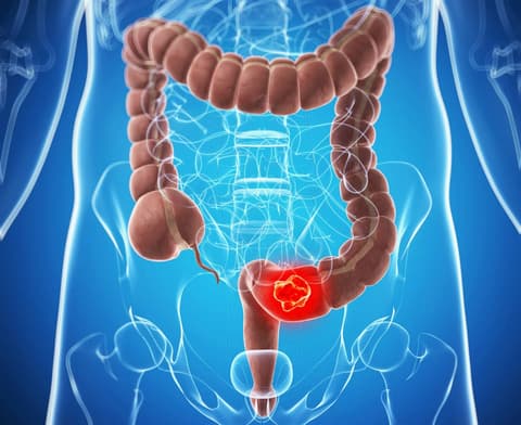 Jelito grube – jak wygląda i gdzie się znajduje? Czy może boleć? Choroby