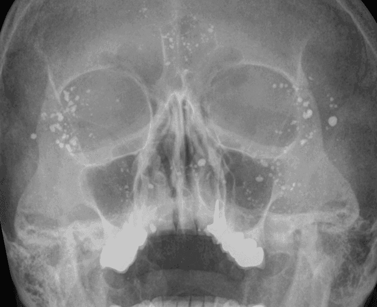 USG nerek – jak przebiega, jakie są wskazania i co można wykryć?