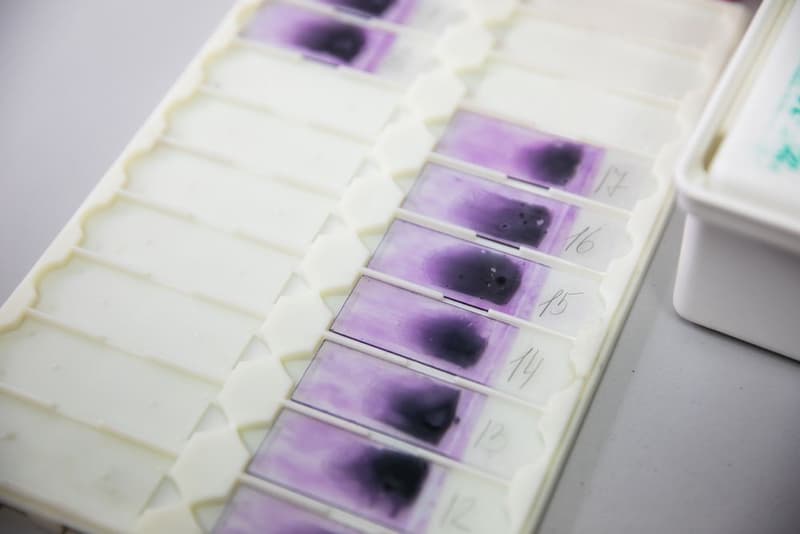 Monocyty podwyższone – co oznaczają w wynikach badania krwi?