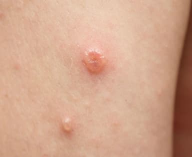 Ziarnina, ziarninowanie – na czym polega gojenie rany przez ziarninowanie?