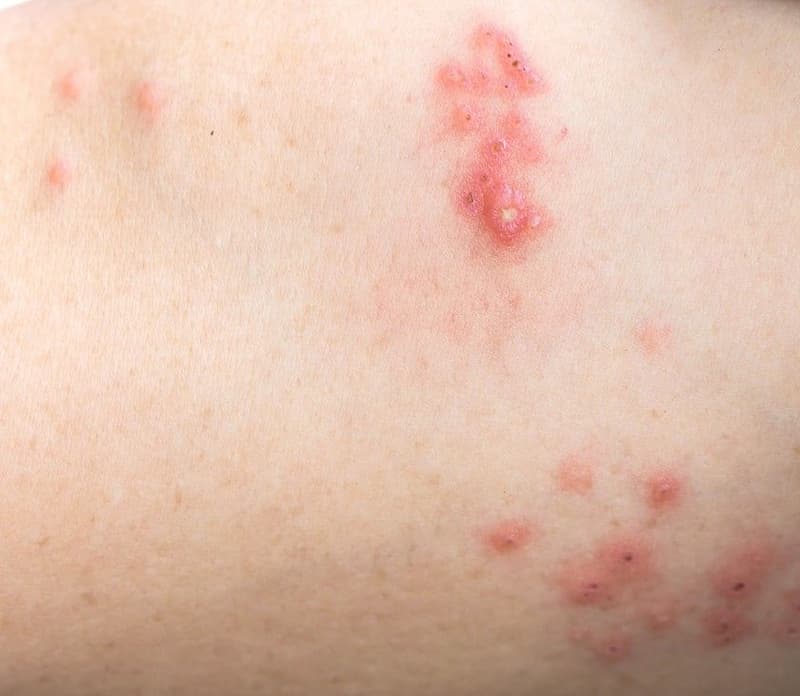 Wysypka na brzuchu i wysypka na plecach – jakie są przyczyny wysypki na ...