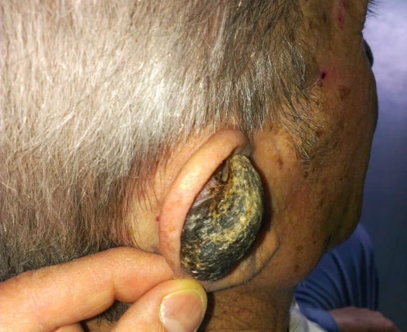 Ziarnina, ziarninowanie – na czym polega gojenie rany przez ziarninowanie?