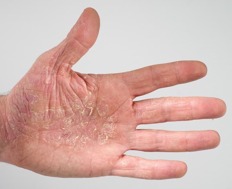 Ziarnina, ziarninowanie – na czym polega gojenie rany przez ziarninowanie?