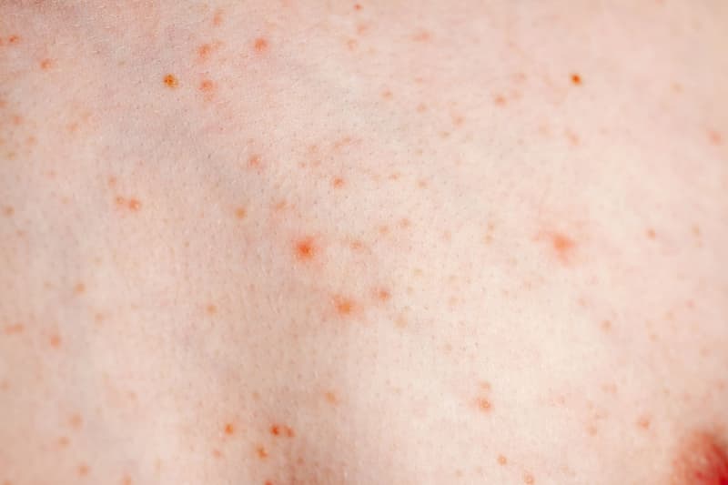 Ziarnina, ziarninowanie – na czym polega gojenie rany przez ziarninowanie?